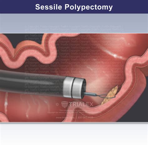 Medical Legal Exhibits Legal Animations And Trial Graphics