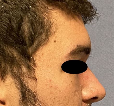 Can A Brow Bone Implant Create A Brow Lowering Effect Explore Plastic Surgery