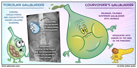 Porcelain Gallbladder