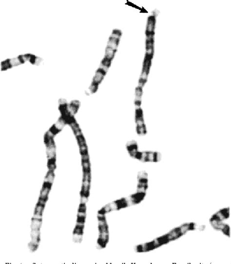 Fragile X Syndrome Semantic Scholar