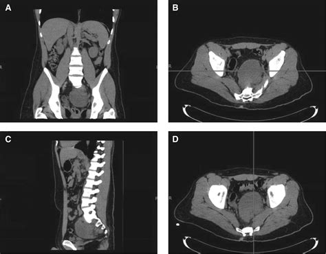 Intraoperative Nerve Monitoring In Robotic Assisted Resectio Operative Neurosurgery