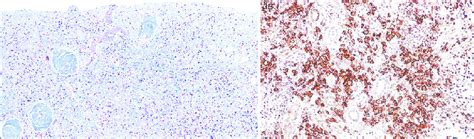 A Expansile Fibroinflammatory Process With Typical Storiform Pattern Download Scientific