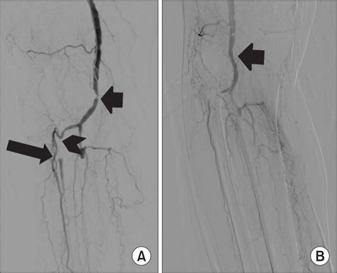 Popliteal To Dorsalis Pedis In Situ Small Saphenous Vein Bypass Under