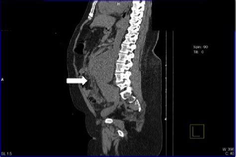 Plain Abdominal CT Scan Sagittal View Without Contrast Shows Large Download Scientific