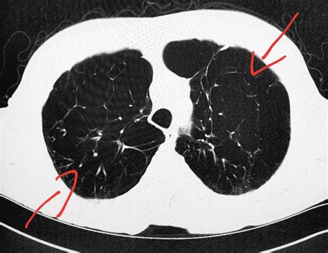 Emphysema Radiology