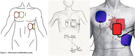 Double Sequential Defibrillation — Staten Island University Hospital