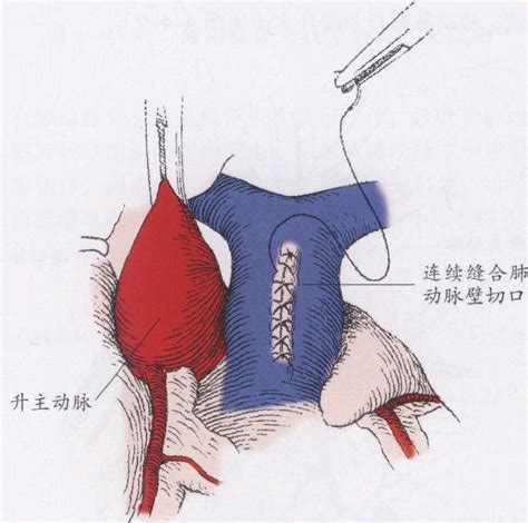 第四节 肺动脉狭窄矫治术 中华手术彩图 医学