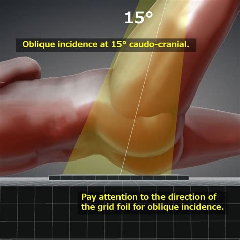 Sacroiliac Joint Oblique View｜tools For Radtech