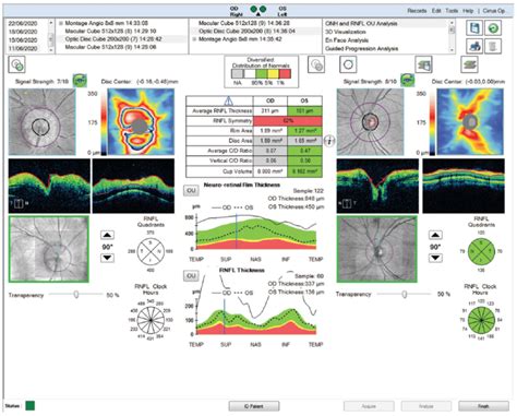 Oct Of Both Optic Nerve Heads 5 Days After First Symptoms There Is A
