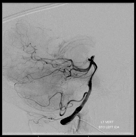 Balloon Test Occlusion