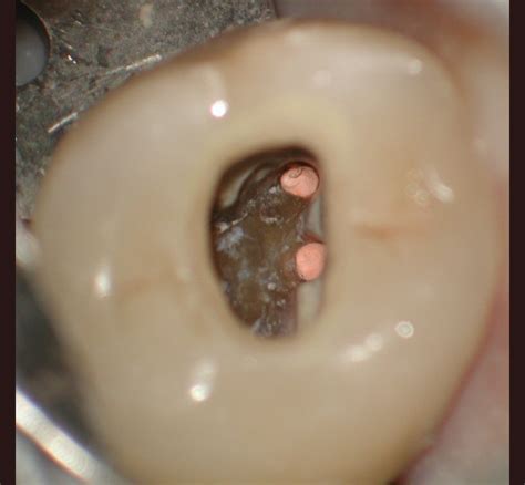 Access Closure Case 1 Modern Endodontic Care