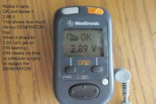 My DBS Story How To Track Your DBS Generator Battery Life Using The Programmer