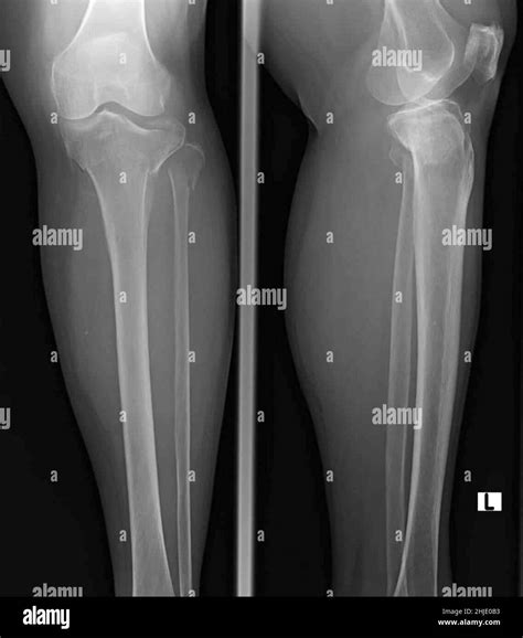 Anatomía De La Tibia Proximal