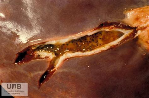 Chronic Colangitis Due To Fasciola Hepatica