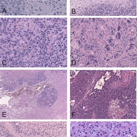 pdf diagnostic evaluation of diffuse gliomas