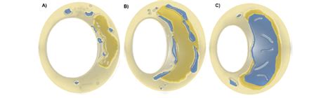 Macrocalcification Geometry Classification On Clinical Imaging A