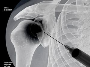 Bone Dislocation Treatment In Austin Dallas And Oklahoma City Direct