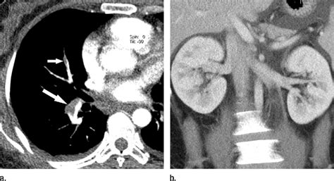 Images In 41 Year Old Woman With Membranous Nephropathy A Axial