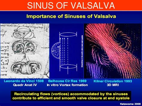Sinus Of Valsalva Aneurysm