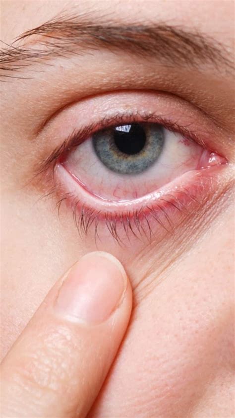 Can Omega 3 Fatty Acids Help Reduce Symptoms Of Pink Eye