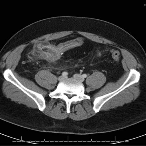 Abdominal Computed Tomography Thickened Terminal Ileum Immediately Download Scientific Diagram