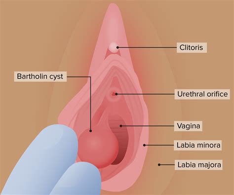 Vaginal Cyst