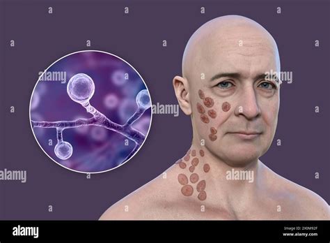 3d Illustration Of A Man With Multiple Face And Neck Lesions Caused By