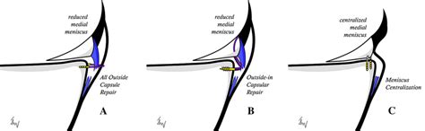 Meniscotibial Repair Techniques A All Outside Capsular Repair B