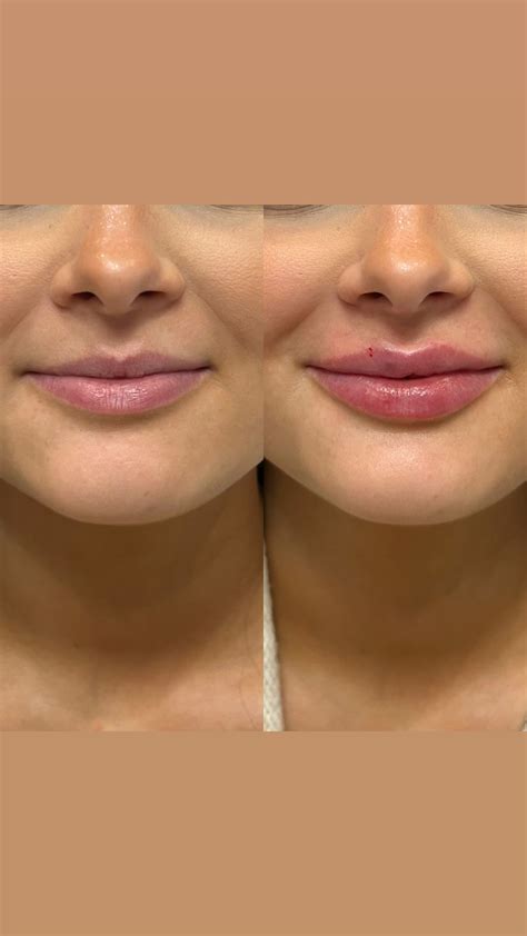 Face Fillers Botox Fillers Dermal Fillers Botox Face Botox Lips