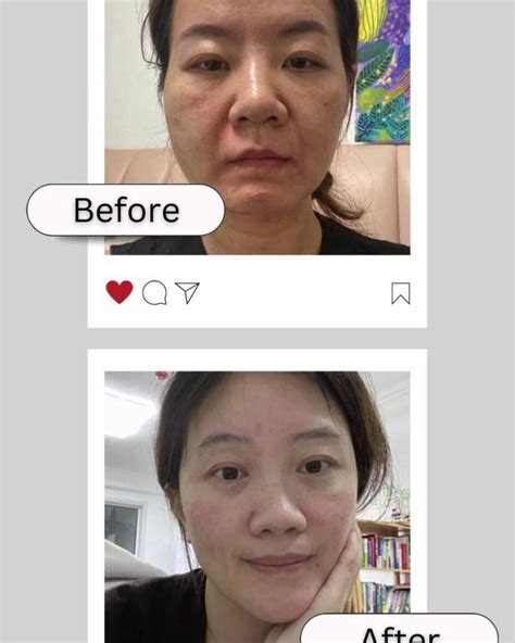 아이코닉성형외과 눈매교정풀기토안증눈재수술 코성형 기능코 수능 끝나면 아이코닉에서 예뻐질 시간 개강~ 여신등극 훈남등극 수능성형이벤트 앞트임