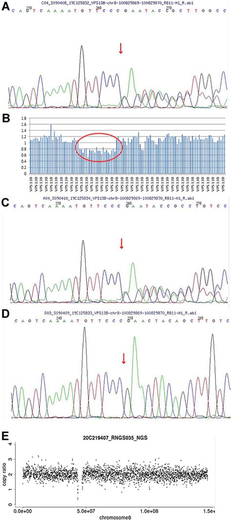 Identification Of A Novel Vps13b Mutation In A Chinese Patient With Co Pgpm