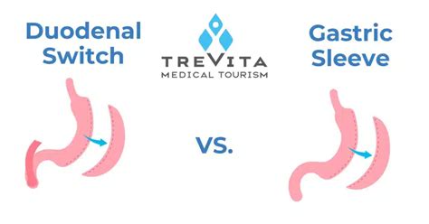Duodenal Switch Vs Sleeve A Comprehensive Comparison