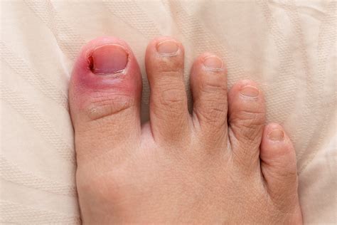 Ingrown Toe Nails Andover Podiatry Clinic