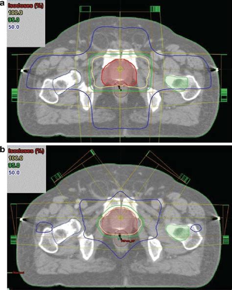 29 Prostate Plans A Phase 1 Four Field Box Technique B Phase 2