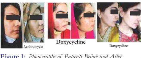 Figure 1 From Comparison Of Efﬁcacy Of Oral Azithromycin Pulse Versus