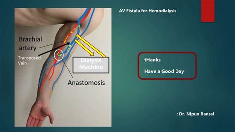 Basilic Vein Transposition By Dr Nipun Bansal