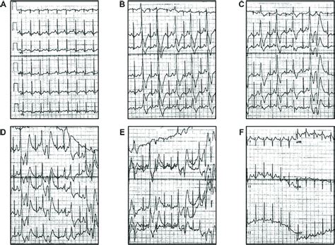 Electrocardiographic Recordings During Treadmill Testing In The Proband Download Scientific