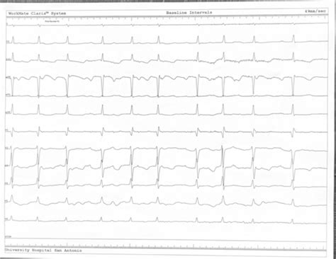 Radiofrequency Ablation Of Crista Terminalis Focal Atrial Tachycardia