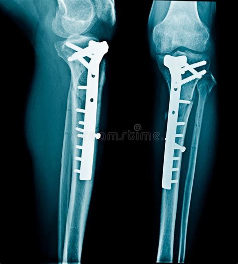Distal Tibia Fracture And Distal Fibular Fusion Stock Image Image Of Accident Bone 115431575