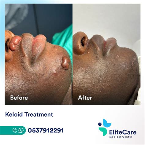 Keloids Treatment In Accra Ghana Elitecare Center
