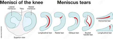 Meniscus Tears Of The Knee Joint Anatomy Injury Labeled Illustration