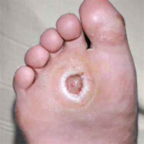 A Comprehensive Guide To Managing Diabetic Foot Ulceration