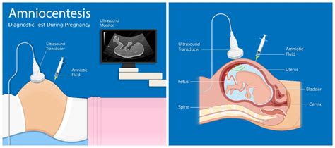 Amniocentesis All You Want To Know