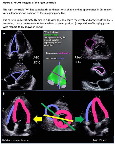 Pocus Spotlight Focused Cardiac Ultrasonography