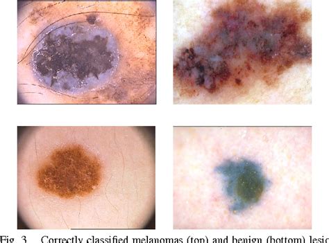figure 1 from melanoma detection algorithm based on feature fusion