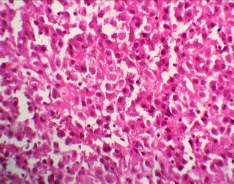Biopsied Specimens Showed A Proliferation Of Monomorphic Cells With