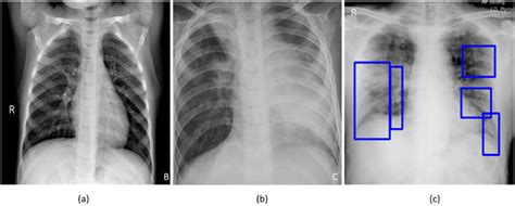 Cxrs Showing A Clear Lungs B Bacterial Pneumonia Infections