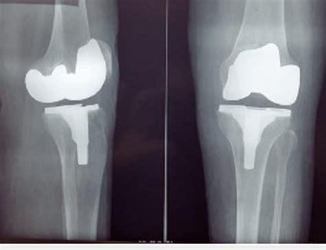 Postoperative Control Two Years After Total Knee Arthroplasty Download Scientific Diagram
