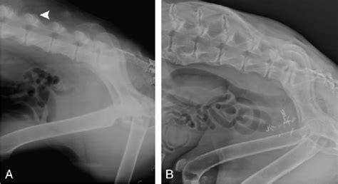 Figure 1 From Bilateral Iliopsoas Muscle Contracture And Spinous Process Impingement In A German