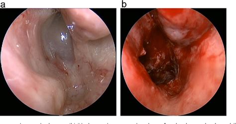 Figure 1 From The Efficacy Of Mitomycin And Stenting In Choanal Atresia